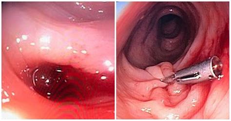 Imagediverticulum With Bleeding Manuale Msd Versione Per I Pazienti