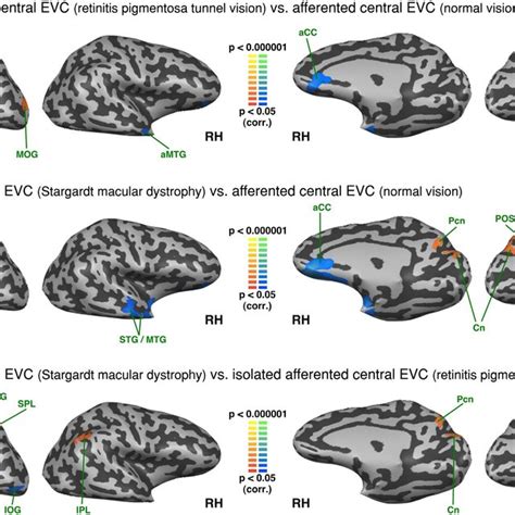 Pdf Reorganization Of Early Visual Cortex Functional Connectivity Following Selective