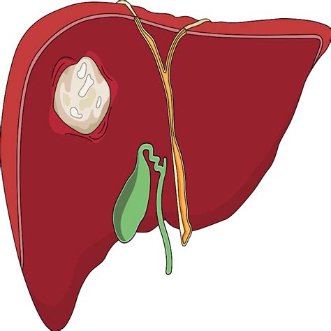 Liver Abscess Figure Science Figures