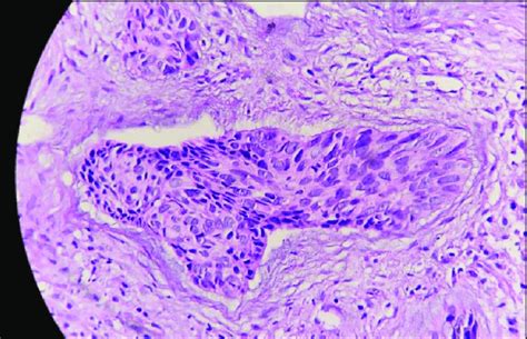 Figure Showing High Power Image Shows Basaloid Epithelial Tumour Cells Download Scientific