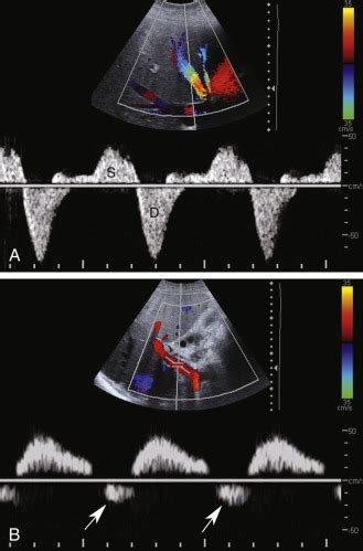 Ultrasound Assessment Of The Hepatic Vasculature Radiology Key