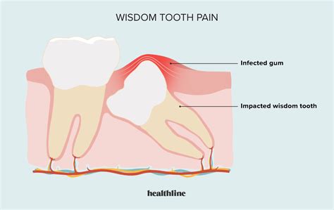 Wisdom Tooth Abscess
