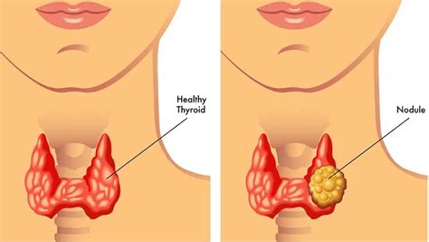 Nódulo Tiroideo Diagnóstico Tipos Y Tratamiento Doctor Online