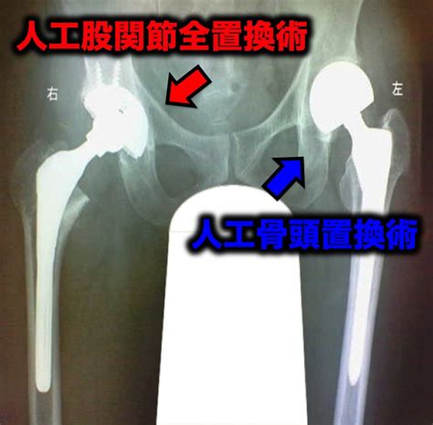 人工股関節全置換術手術方法 人工股関節置換術 可動域制限 Ohihe