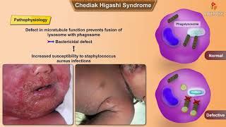 Chediak Higashi Syndrome