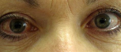 Glaucoma Juvenil Sintomas Archives Prof Doutor Salgado Borges