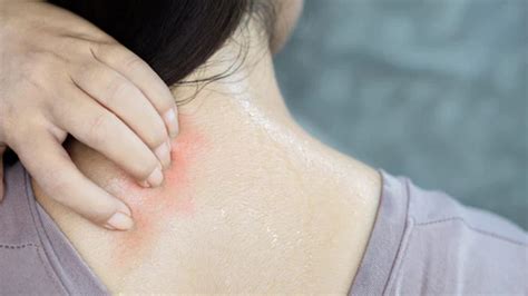 Struggling With Heat Rashes Essential Tips To Get Rid Of The Skin Issue During Summer