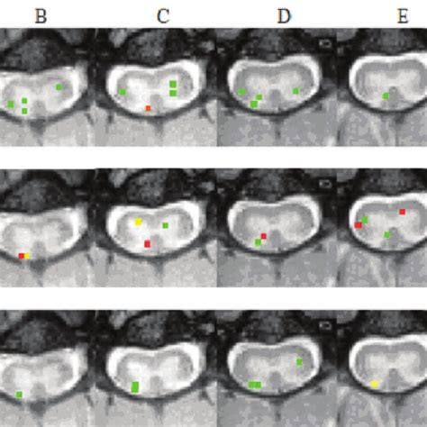 Pdf Magnetic Resonance Imaging Of Neuronal Function In The Spinal
