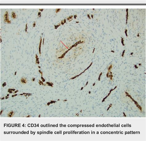 Figure 4 From A Rare Case Of Angioleiomyoma Of The Hand Semantic Scholar