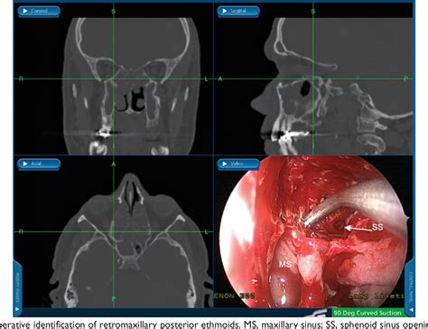 Figure 2 From Retromaxillary Pneumatization Of Posterior Ethmoid Air