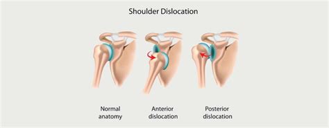 Multidirectional Instability Mdi Motus Physical Therapy