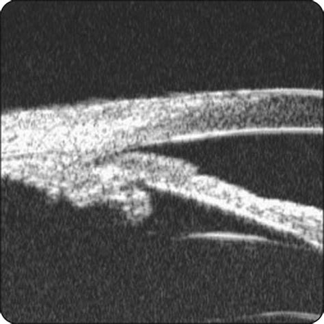 Glaucoma Clinical Tree