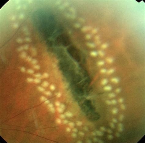 What Is Paving Stone Degeneration Of Retina At Thomas Pritchett Blog