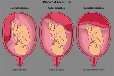 خروج جفت از رحم 09218571452