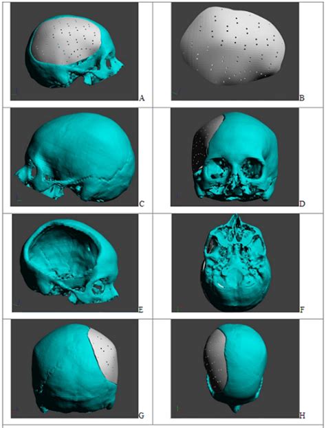 Cranial Reconstruction Archives Perfect D Printing Filament