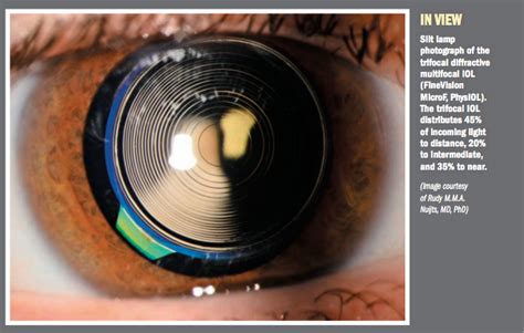 Вперше лінзи останнього покоління Alcon Panoptix — Клініка