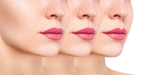14 Lip Filler Shapes How To Choose The Right Type
