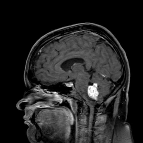 Choroid Plexus Papilloma Cpp Pacs