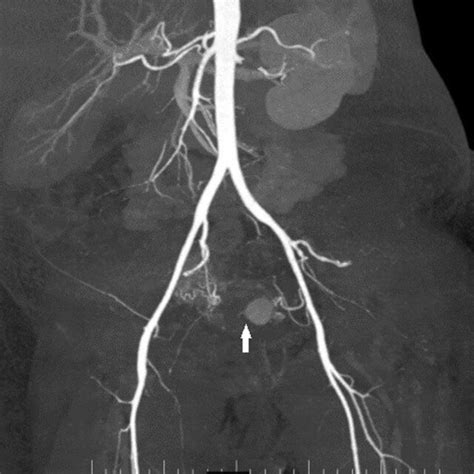 Selective Catheterization Of Left Internal Iliac Artery Showing Download Scientific Diagram