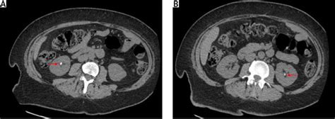 Primary Hyperparathyroidism Clinical Manifestations Diagnosis And