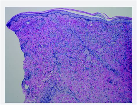 Atypical Vascular Proliferation Consistent With Nodular Kaposis