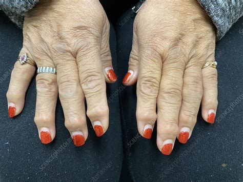 Heberden S Nodes Mucous Cyst — The Manchester Hand Clinic