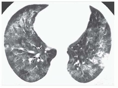 Diffuse Pulmonary Hemorrhage And Pulmonary Vasculitis Radiology Key