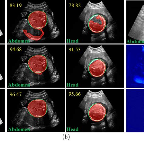 Illustration Of Segmentation Degradation On A Fetal Abdomen And B Download Scientific