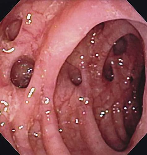 Diverticulosis Bleeding