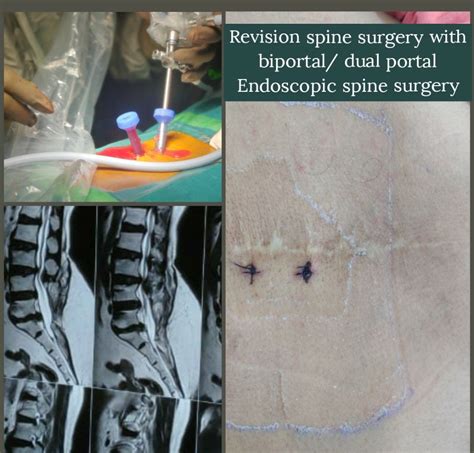 Endoscopicspinesurgery Biportal Dualportal Revisionspinesurgery