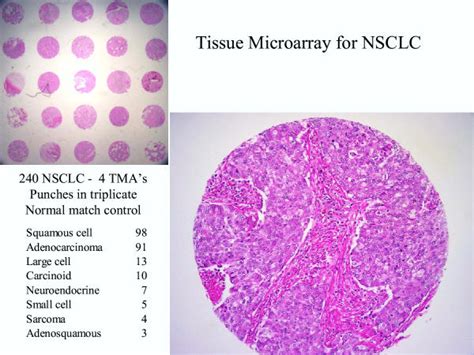 Tissue Microarrays Tmas Of Lung Cancer Tmas Are Comprised Of Core Download Scientific