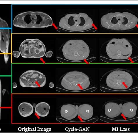 Typical Examples Of Synthesizing Ct Images From A Whole Body Mr Image