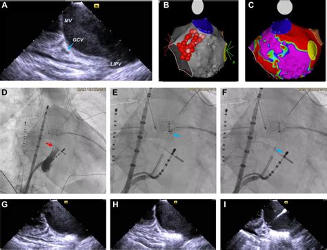 Anatomic Approach To Mitral Isthmus Ablation Guided By Left Atrial