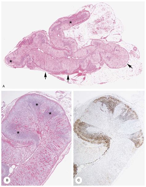 Cortical Hyperplasia And Cortical Atrophy Case 10 A Areas Of