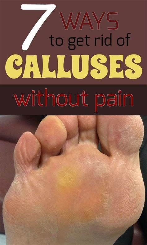 7 Ways To Get Rid Of Calluses Without Pain Healthy Lifestyle