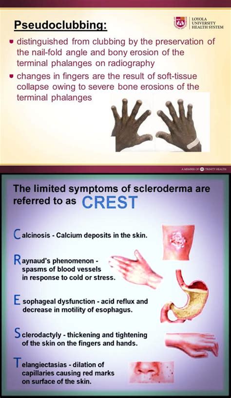 Crest Syndrome Scleroderma Basic Science Orthobullets