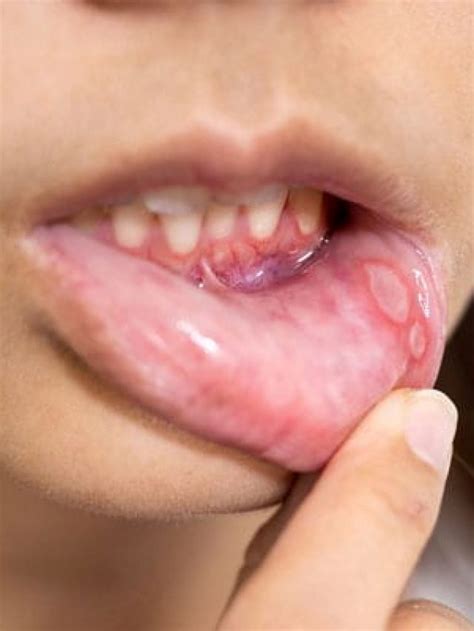 इस विटामिन की कमी के कारण मुंह में होते हैं छाले