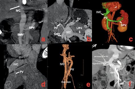 Svspv Splenic Vein Ivc Inferior Vena Cava Pv Portal Vein Smv