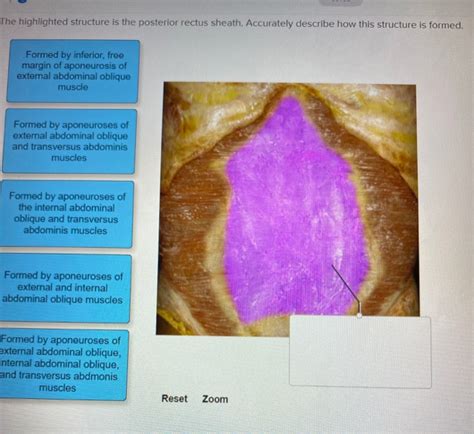 Posterior Rectus Sheath