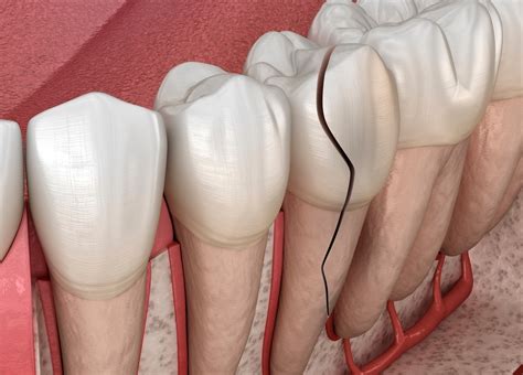 Tooth Fracture Immediate Steps And Long Term Solutions