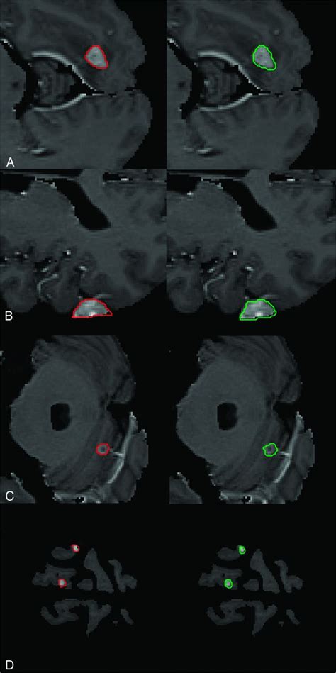 Segmentation Of Brain Metastases Using Background Layer Statistics Blast American Journal Of