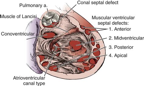 Ventricular Septal Defect And Double Outlet Right Ventricle Clinical Tree