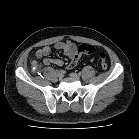Axial CT Image Arrow Indicates Appendicolith Present Within The Download Scientific Diagram