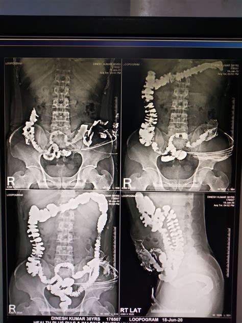 Loopogram Fluoroscopy Procedure Examination Performed Under X Ray