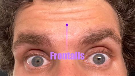 The Cosmetic Side Effects Of Botox® For Migraine And How To Avoid