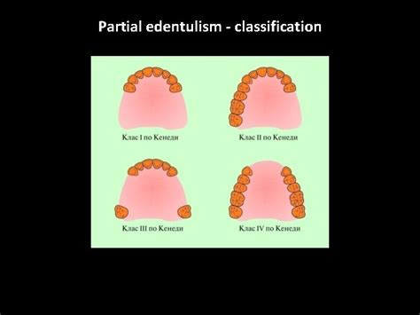 Removable Partial Dentures Prof Dr Bozhidar Yordanov Classification