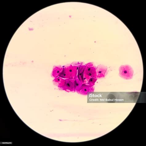 자궁 경부 얼룩 세포학의 현미경 이미지 심한 염증과 관련된 반응성 세포 변화 상피 세포의 클러스터 40x 초점 보기 편평상피에 대한 스톡 사진 및 기타 이미지 Istock