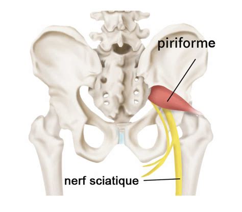 Soulager Efficacement Le Syndrome Du Piriforme En Une Seule Séance