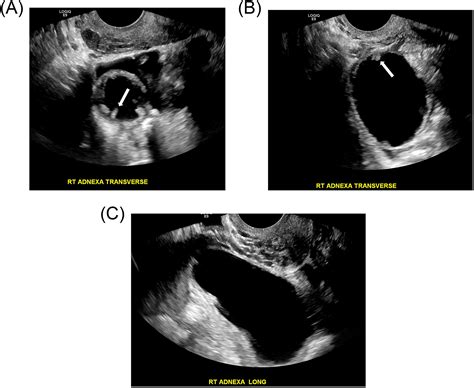 Linear Ultrasound Hydrosalpinx