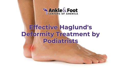Effective Haglunds Deformity Treatment By Podiatrists